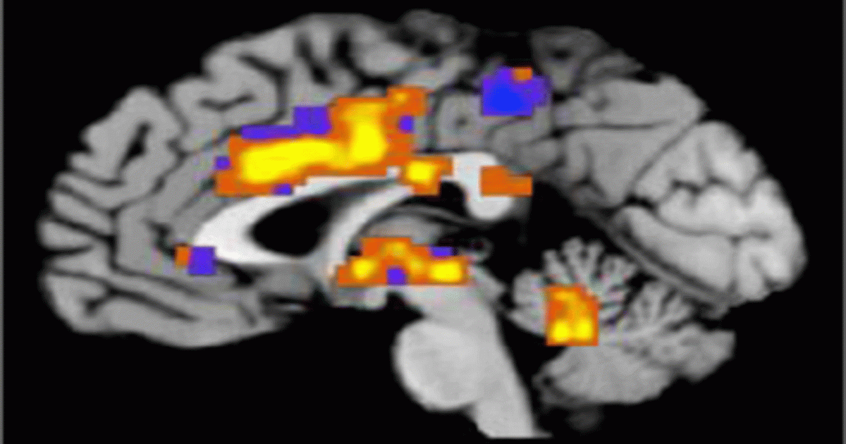 Doctors use brain scans to 'see' and measure pain