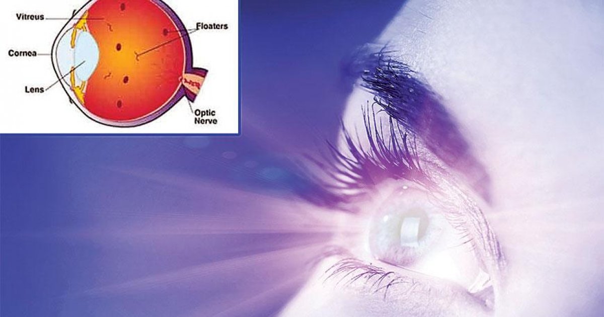 Dealing with flashes and floaters in the eyes