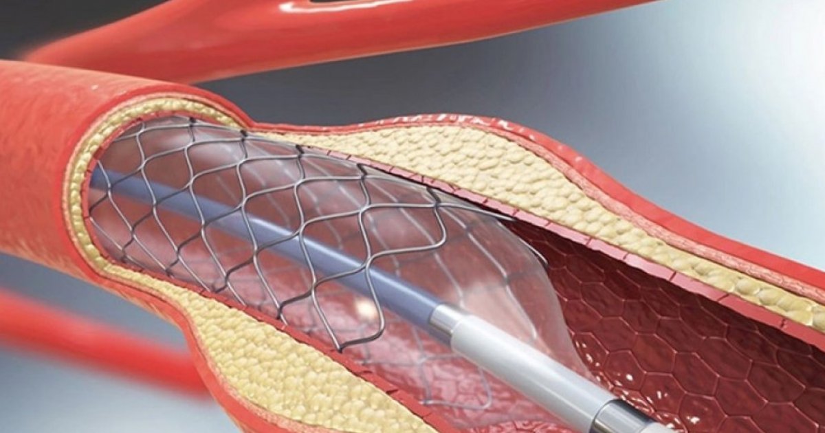 Bangladesh achieves milestone as robot assists in heart ring placement