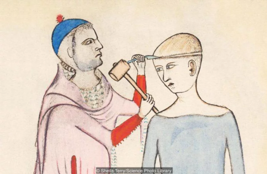 Why our ancestors drilled holes in each other's skulls